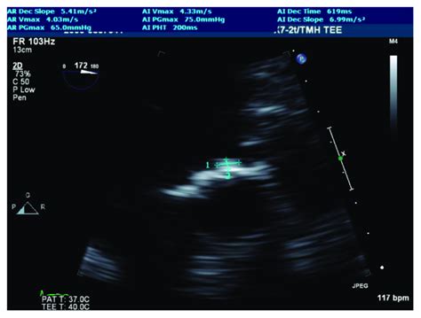 Zoomed In Transesophageal Echocardiogram Deep Transgastric View Of The