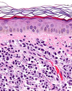 Mastocytosis Libre Pathology