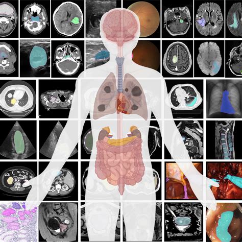 medical image segmentation datasets hi gmisnet kaggle