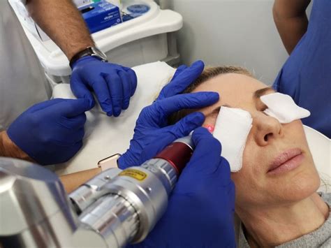 Laserowe usuwanie przebarwień Wrocław Warszawa Ars Estetica