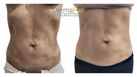 Tratamiento Fibrosis Post Operatoria Dermapiel