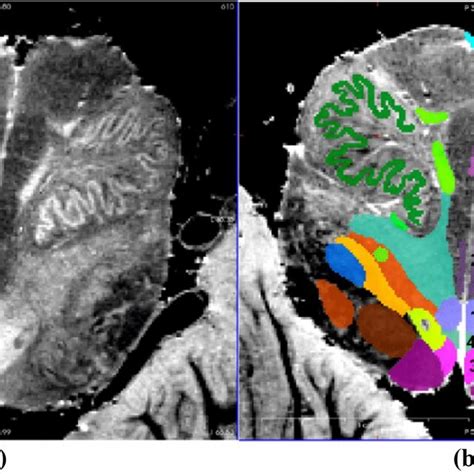 Segmentation Of The Right Superior Colliculus Axial Slice