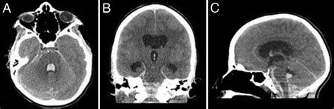 Noncontrast Enhanced Ct Scan Of The Brain With The A Axial Plane