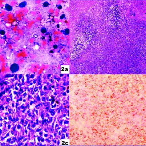 Pdf Primary Splenic Lymphoma Presenting As Splenic Abscess A Rare