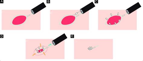 Purse String Suturing Using Endoloop And Clips A An Endoloop Is