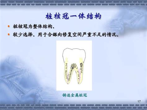 桩核冠 贴面 word文档在线阅读与下载 免费文档