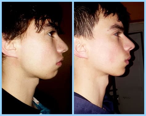 Mewing Transformation Before And After Geye