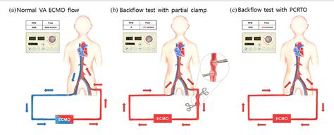 Figure 1 From Early Experience Of Pump Controlled Retrograde Trial Off