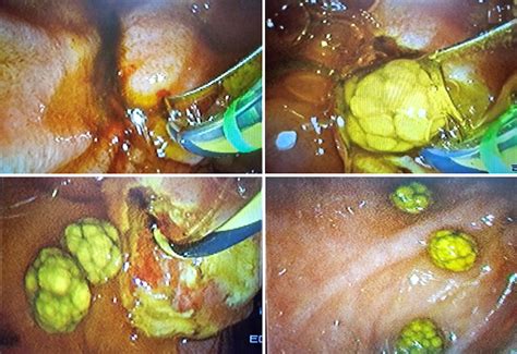Rendezvous Laparo Endoscopic Management Of Cholecysto Choledocholithiasis A Comparison
