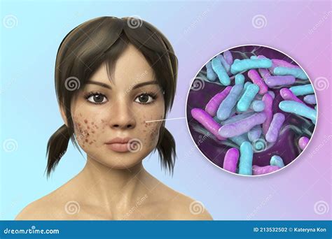 Acne Vulgaris On Skin And Closeup View Of Bacteria Cutibacterium Acnes
