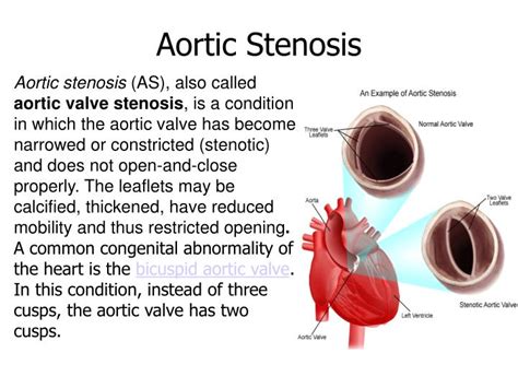 Ppt Aortic Valve Disease Powerpoint Presentation Id391667