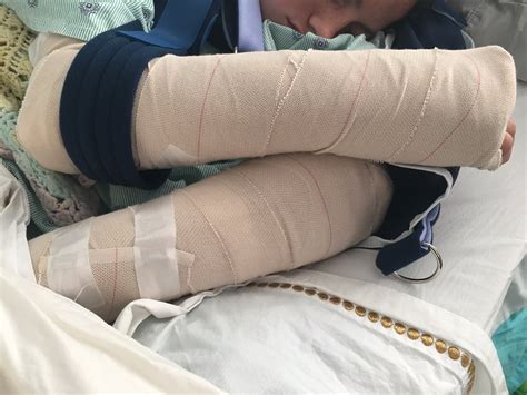 Both Arms Broken