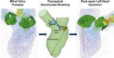 Computer Simulations Of Transapical Mitral Valve Repair With Neochordae