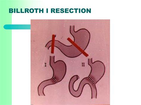 Billroth Surgery