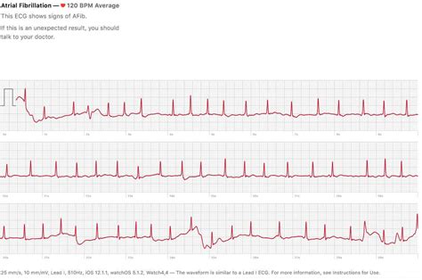 Apple Watch Ecg