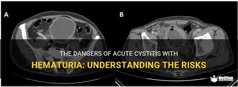 The Dangers Of Acute Cystitis With Hematuria Understanding The Risks