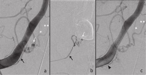 Angiography Of The Right Vertebral Artery From An Anterioposterior View Download Scientific