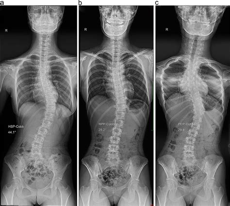 The Role Of The Paraspinal Muscles In The Development Of Adolescent