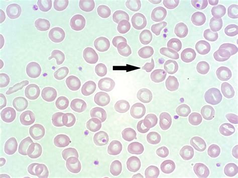 Ovalocytes 1 Meaning Red Blood Cell Morphology Size Shape Color