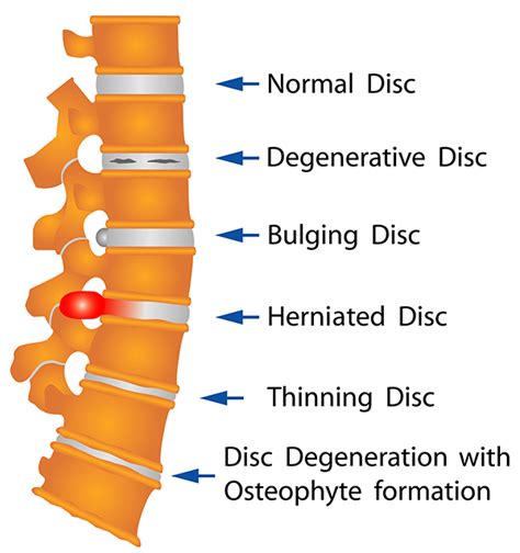 Herniated Disc Nwa Neurosurgery Clinic Willow Creek