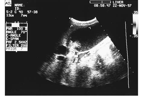 病例4 70 胆囊癌1 超声读片