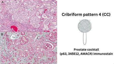 Prostate Carcinoma Cribriform Pattern 4 Cc And Intraductal Carcinoma Idc To The Capra S Tool