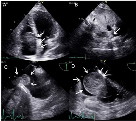 A Apical Axis 4 Chamber Transthoracic Echocardiogram Tte Shows A