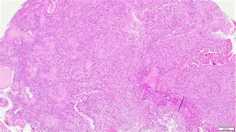 Ependymoma Explained Adventures In Neuropathology Youtube
