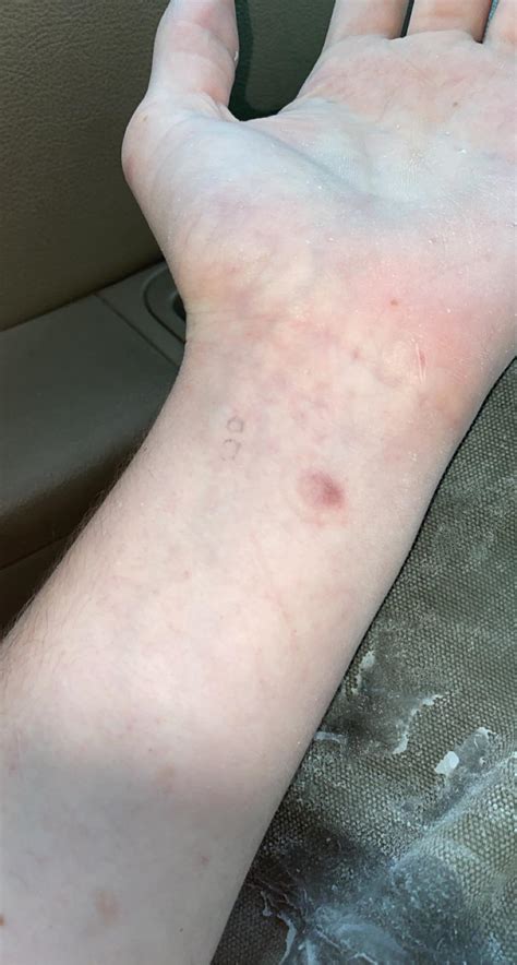 Its Been 9 Months Since This Lighter Burn Was One Of Those Red Hot Car