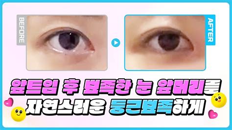 앞트임 후에 뾰족한 눈 앞머리 때문에 스트레스라면 Youtube
