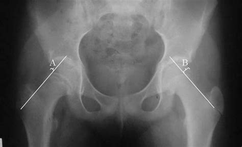 Kleins Line Or Line Of Klein Is Drawn Along The Lateral Aspect Of