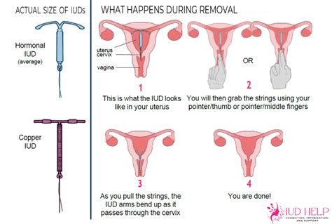 Iud Self Removal Guide Iud Help