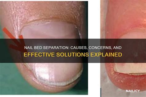 Nail Bed Separation Causes Concerns And Effective Solutions