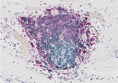 Les Lymphocytes B De Nouveaux Alliés Pour Le Traitement Des Sarcomes