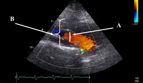 Echo Color Doppler Image B Mode Long Axis Of True Lumen A Visible Download Scientific