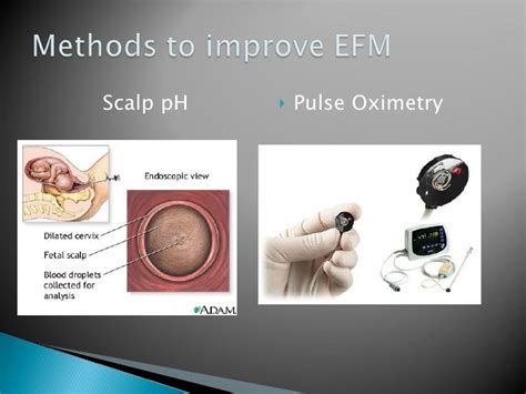 St Segment Analysis Stan For Intrapartum Electronic Fetal Monitoring