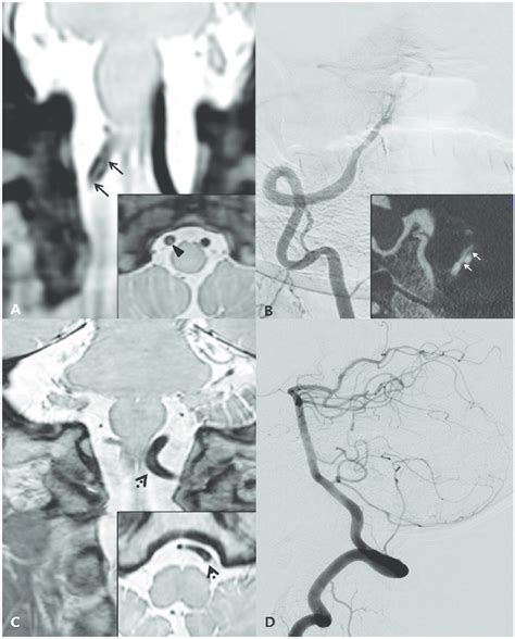 Representative Images Of A True Intimal Flap And Flow Artifact A B Download Scientific
