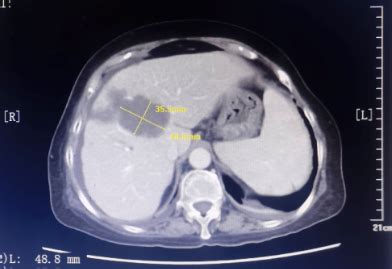 肿瘤内科完成医院首例3D可视化手术规划系统辅助超声引导下转移性肝癌微波消融术 陕西省人民医院