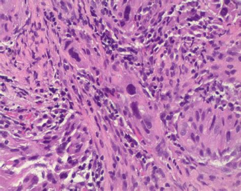 Anaplastic Thyroid Carcinoma High Power Download Scientific Diagram