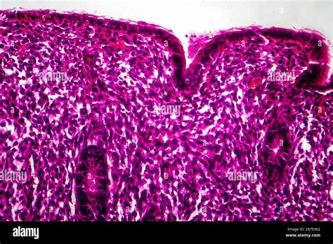 Endometrial Hyperplasia Light Micrograph Of A Section Through Tissue From The Endometrium In A