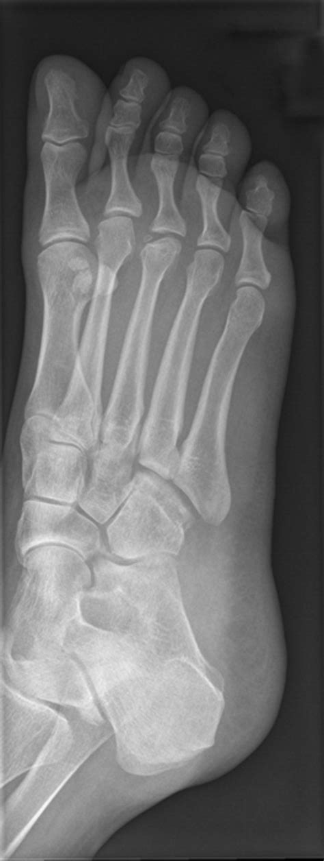The Patterns Of Injury And Management Of Cuboid Fractures Bone And Joint