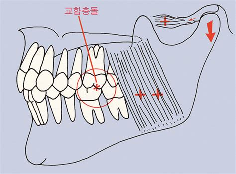 턱관절 장애의 원인 라이프플라자