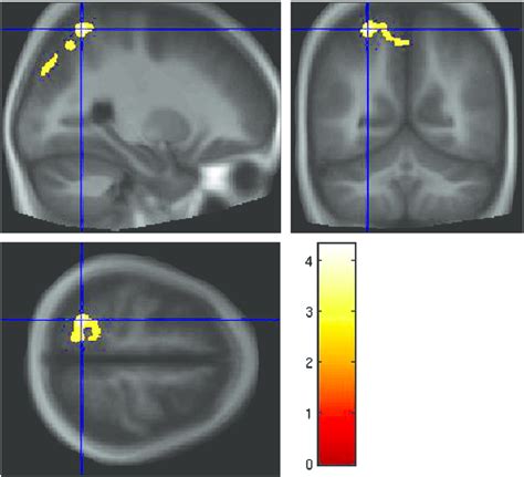 Regions Where Gray Matter Volume Was Negatively Correlated With Sq C