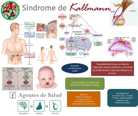 Agentes De Salud Síndrome De Kallmann