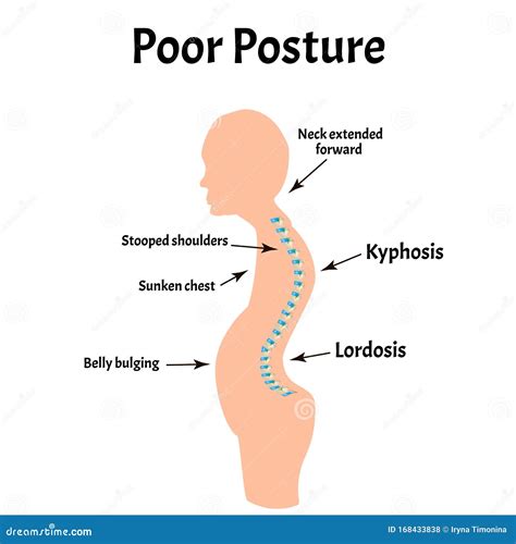 Kyphosis Lordosis Flat Vector Illustration 181853963