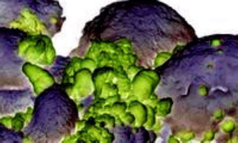 سرطان سينه، شايع ترين سرطان در زنان