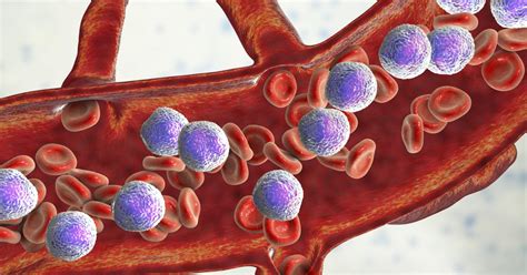 Acute Lymphoblastic Leukemia Explained By Top Doctor