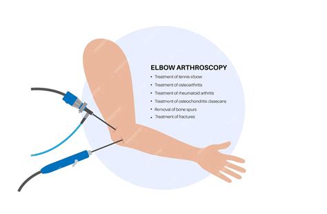 Premium Vector Elbow Joint Minimally Invasive Surgery Arthroscopy Medical Procedure