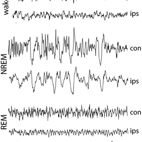 Effects Of Stroke On Eeg Spectrum Slopes A Representative Nrem