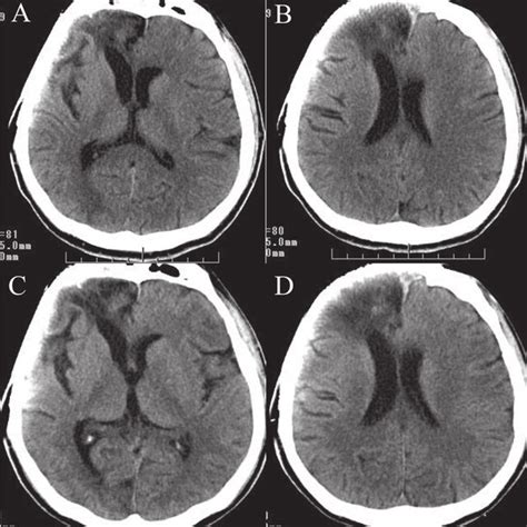 Ct Scan Revealed No Early Abnormalities In The Left Mca Area And The Download Scientific